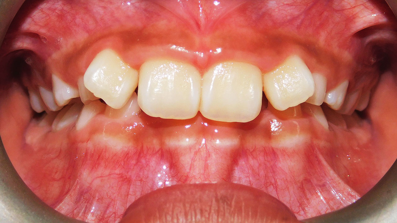Class II, Division 2 Malocclusion, Excessive Overjet and Overbite ...