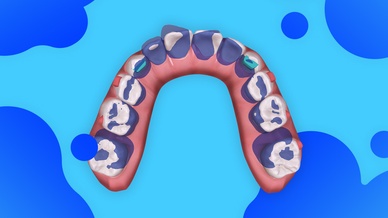 [Premium] Phase I Class II Distalization Rx - Invisalign First