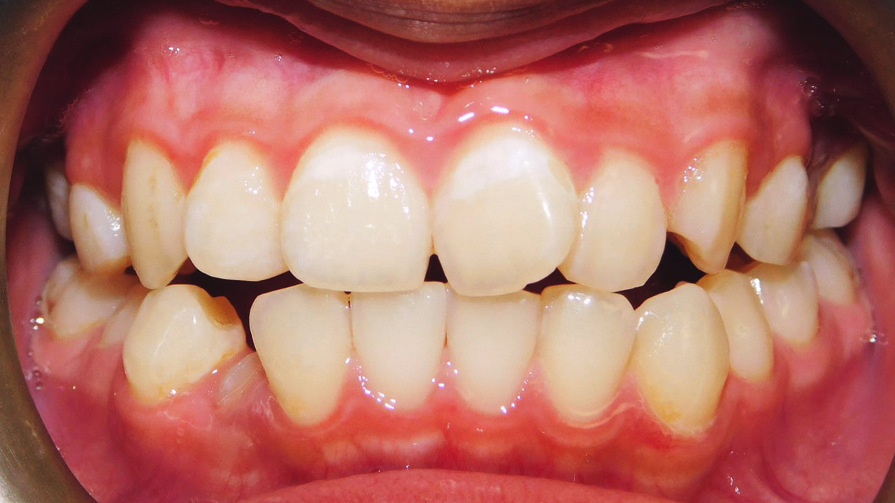 Class II Left, Class III Right Malocclusion, Severe Dental Crowding ...