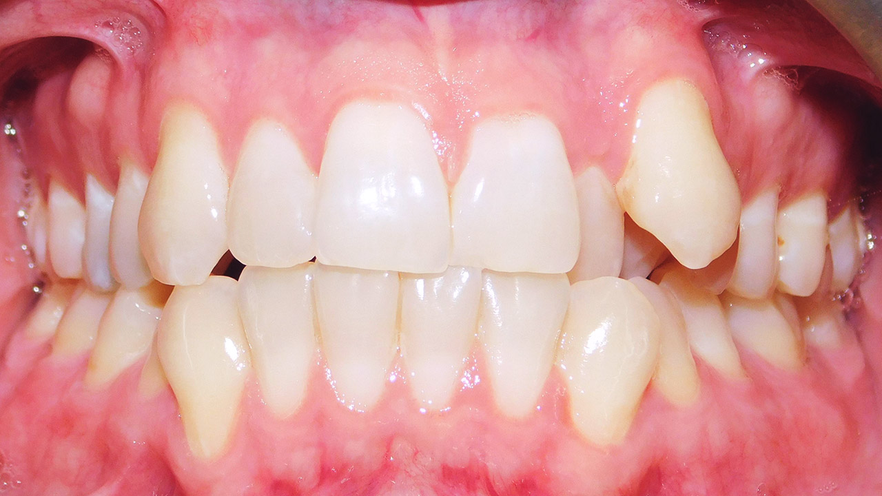 Class III Malocclusion, Severe Crowding, Blocked-out Canine, Midline ...