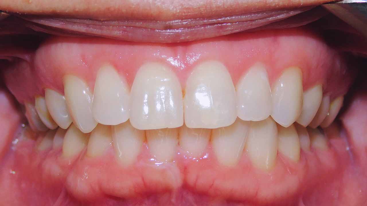 Class II, Subdivision Right Malocclusion, Excessive Overjet - Case Gallery