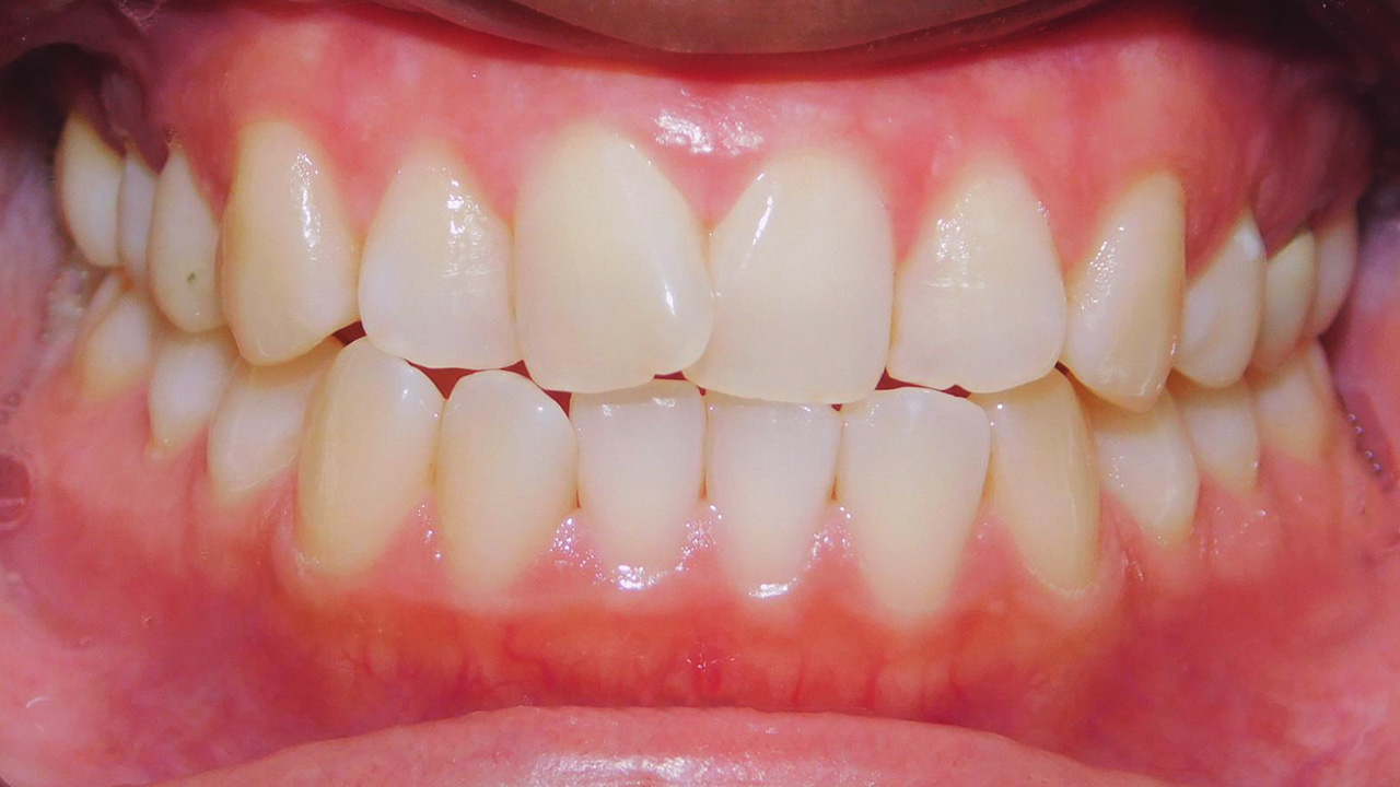 Class III Malocclusion Edge To Edge Bite Anterior Open Bite Severe