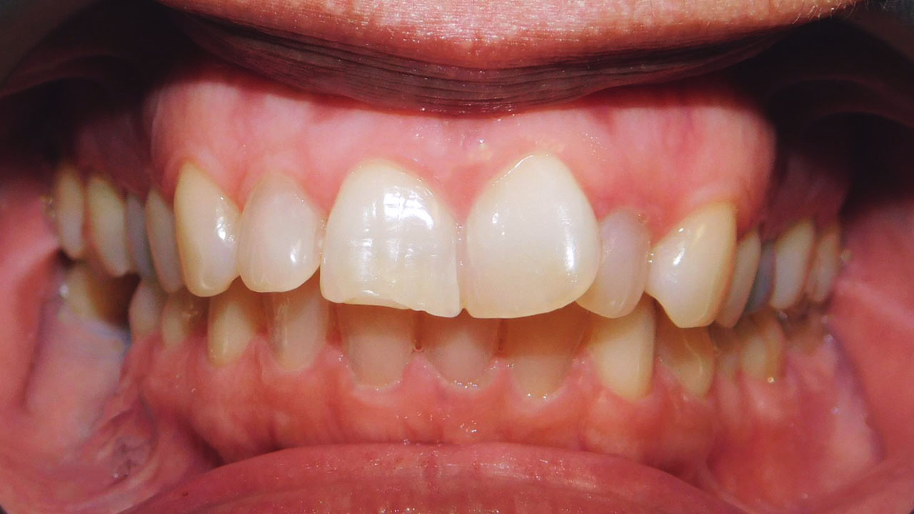 Class Ii Subdivision Right Malocclusion Class Ii Skeletal Excessive