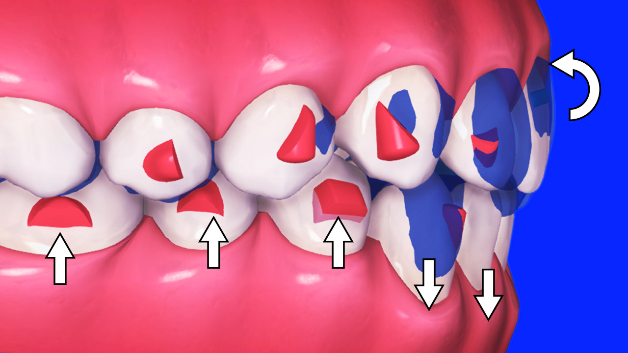 Biomechanics for Clear Aligner Deep Bite Cases - Biomechanics