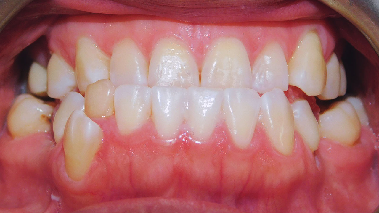 Class III Deep Bite - ClinCheck Ninja - OrthoMasterClass